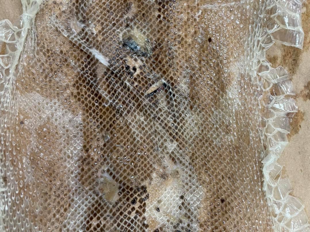 Grimm’s Dermal Necrosis