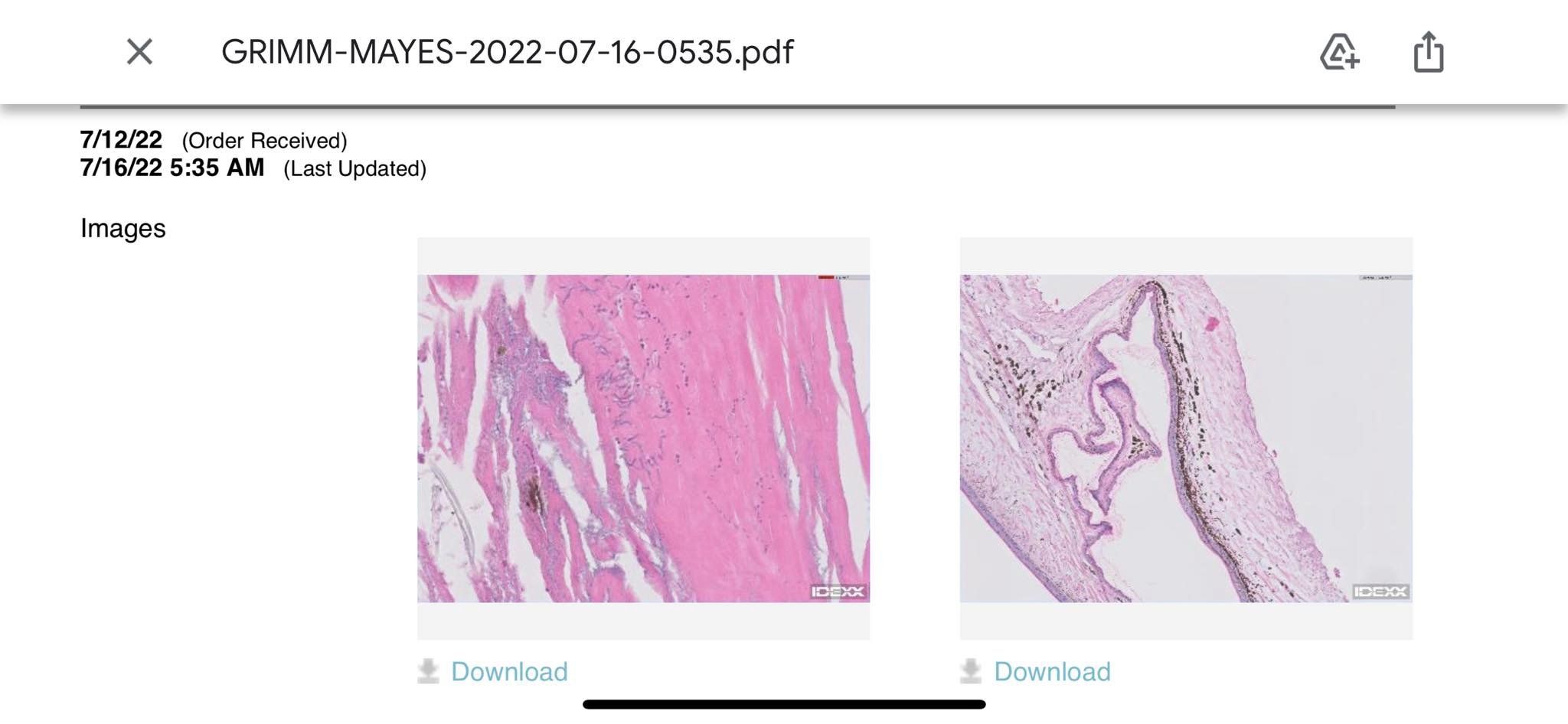Grimm’s Dermal Necrosis